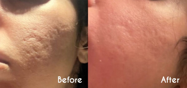 Effective Acne Scar Treatments: 3 Most Asked Questions