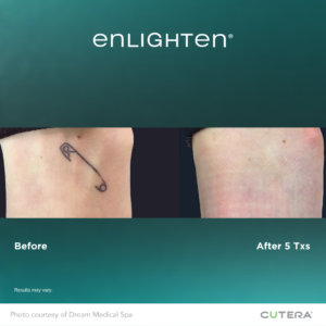 The Ultimate #1 Guide For Laser Tattoo Removal Treatment